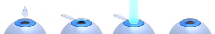 LASIK Surgery At Eye Surgeons of Indiana - Indianapolis
